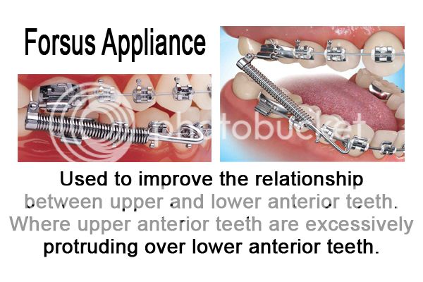 Forsus - Dung Orthodontics - Honolulu and Aiea Orthodontist on Oahu Hawaii