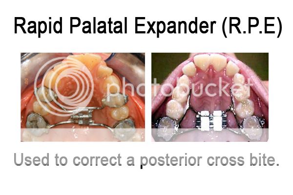 Rapid Palatal Expander (RPE)